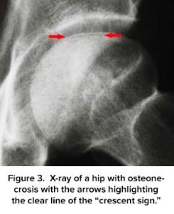 Osteonecrosis of the Hip - AAHKS