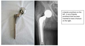 Replacement Surgery for Hip Fractures - AAHKS