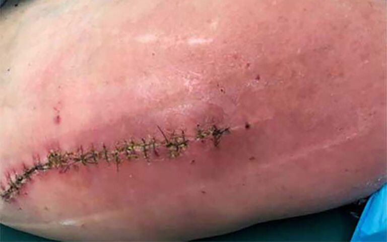 Infection and Your Hip Replacement - AAHKS